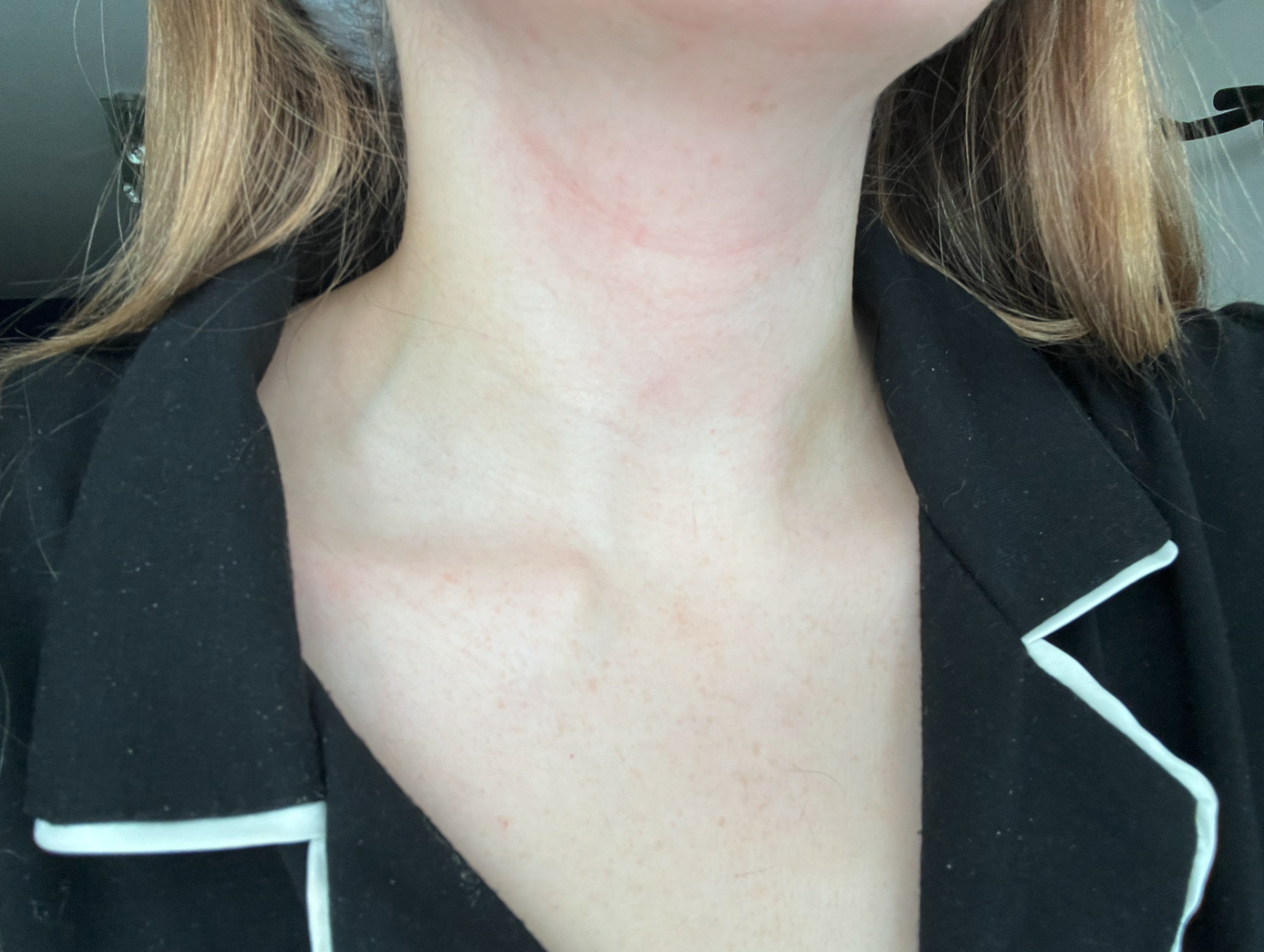 Best Soap for Intertrigo Skin Rash: Causes & Treatment - Natalie O'Neill