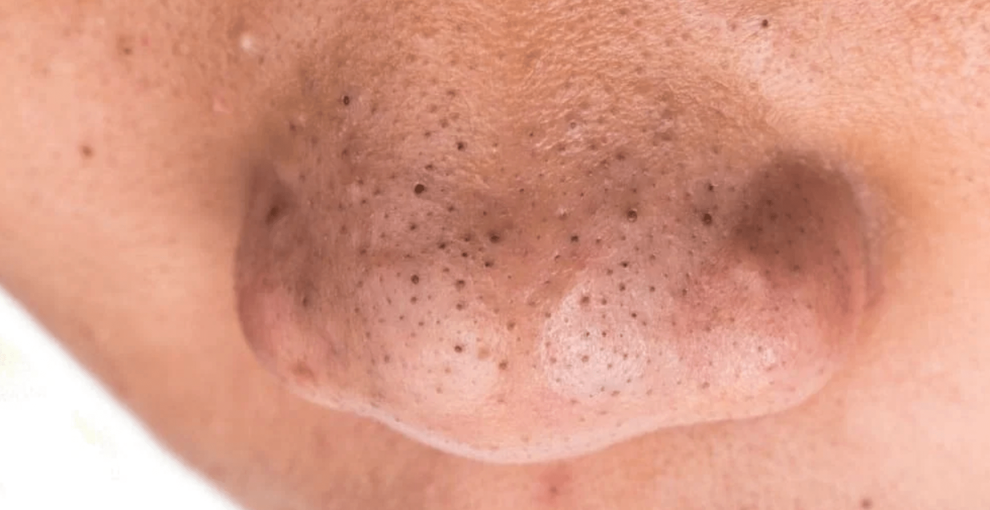 How to Minimise Sebaceous Filaments with this Viral Hack