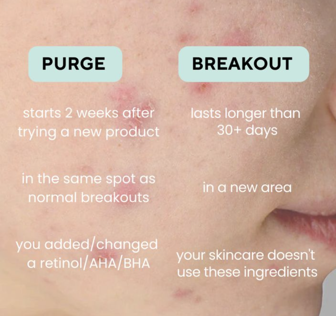 The 10 Best Anua Products for Acne Prone Skin - Natalie O'Neill