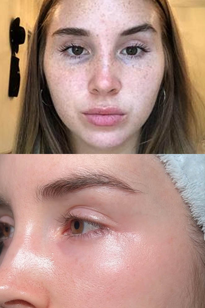 Does Retinol Get Rid of Freckles? Before and After - Natalie O'Neill